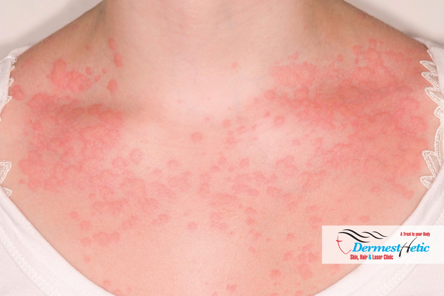 Urticaria (Hives) - Dermesthetic Clinic