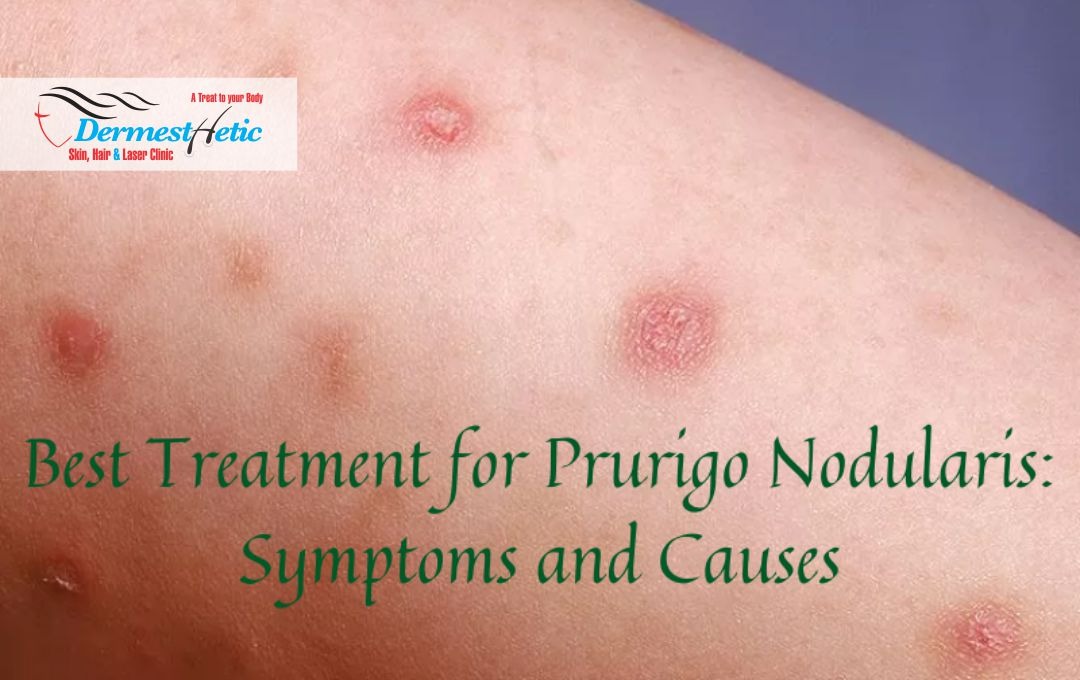 Nodular Prurigo (NP) / Prurigo Nodularis - Dermesthetic Clinic